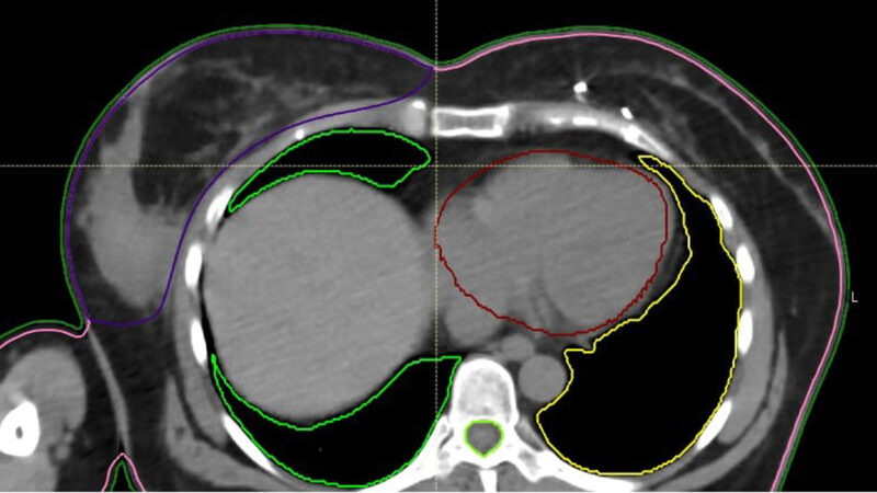 Marcadores Fiduciales De Carbono – FIMECORP